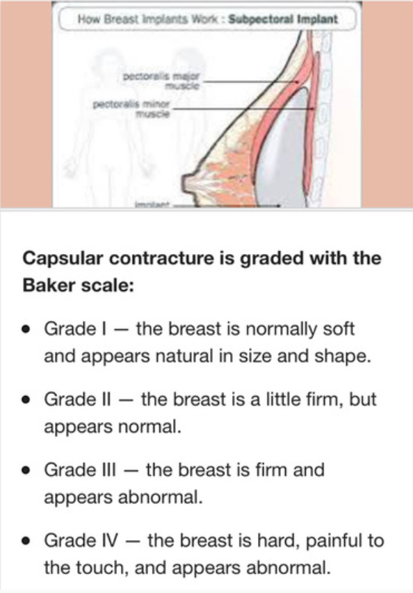 Capsular Contracture Surgery Video and Results