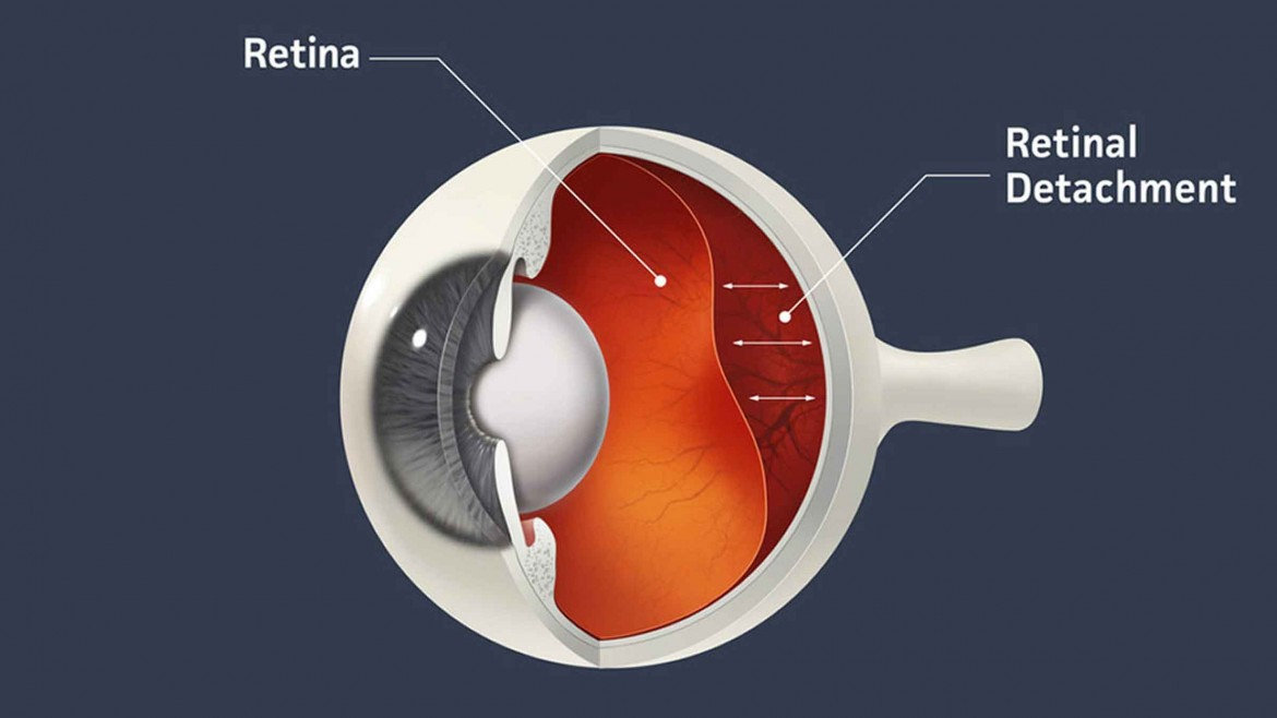 Retinal Detachment | TrinidadEyeHospital