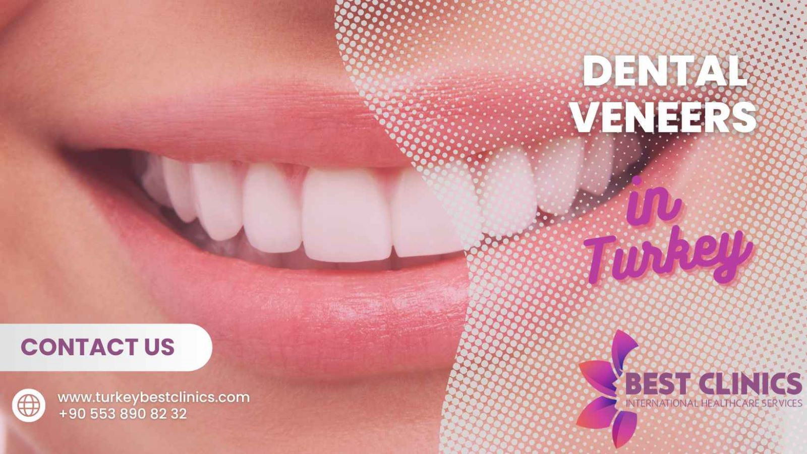 Veneers in Turkey - The Full Guide to Dental Veneers in Turkey Istanbul
