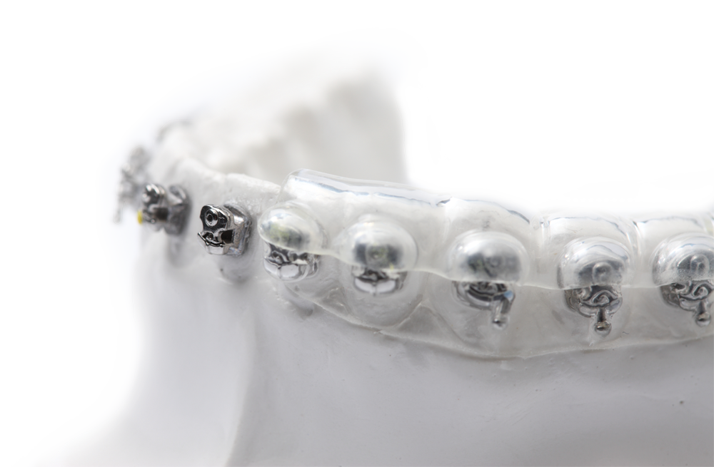 Colocación de brackets en la mitad de tiempo. | OrtoNovo Clínica Dental