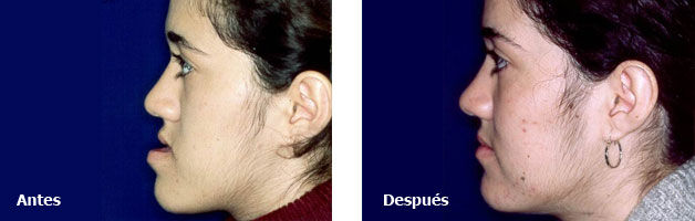 Prognatismo Mandibular