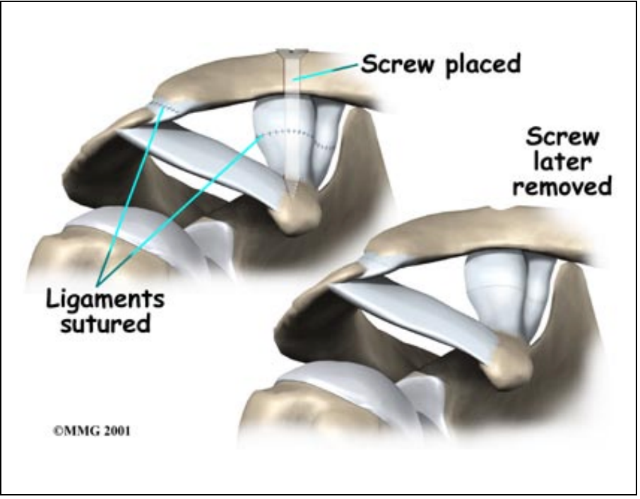 What is an AC Joint Separation?