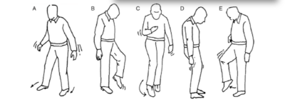 Alteraciones de la marcha