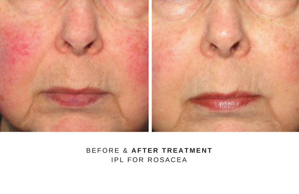 IPL - Before and After