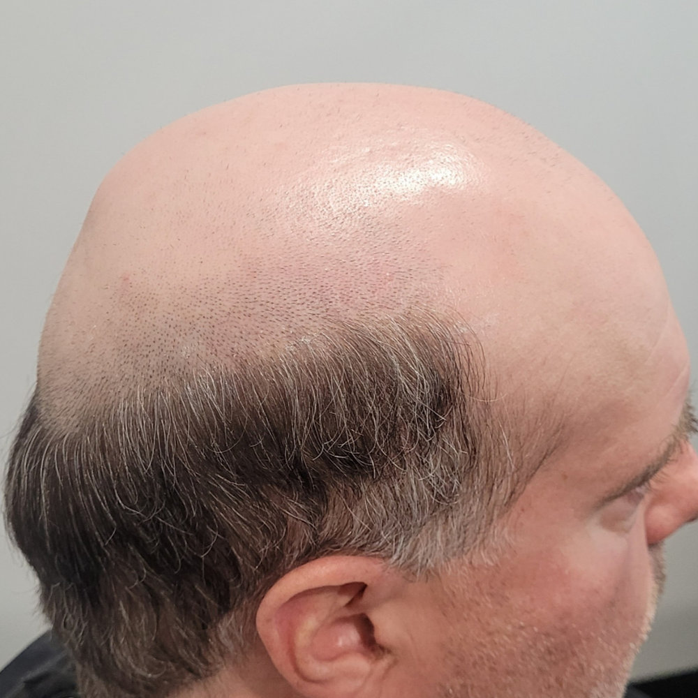 Understanding Male Hair Loss: Causes and Treatments
