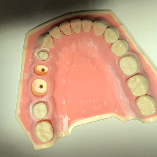 Conventional bridge MCC & GSC(posterior) | Toothpreps