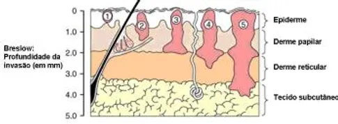 Melanoma