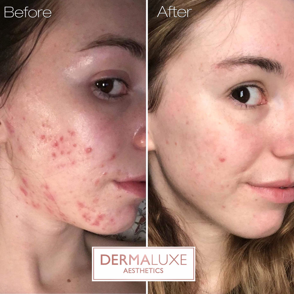 Mollie's Acne Journey : Treating & Managing Hormonal Cystic Acne with ...