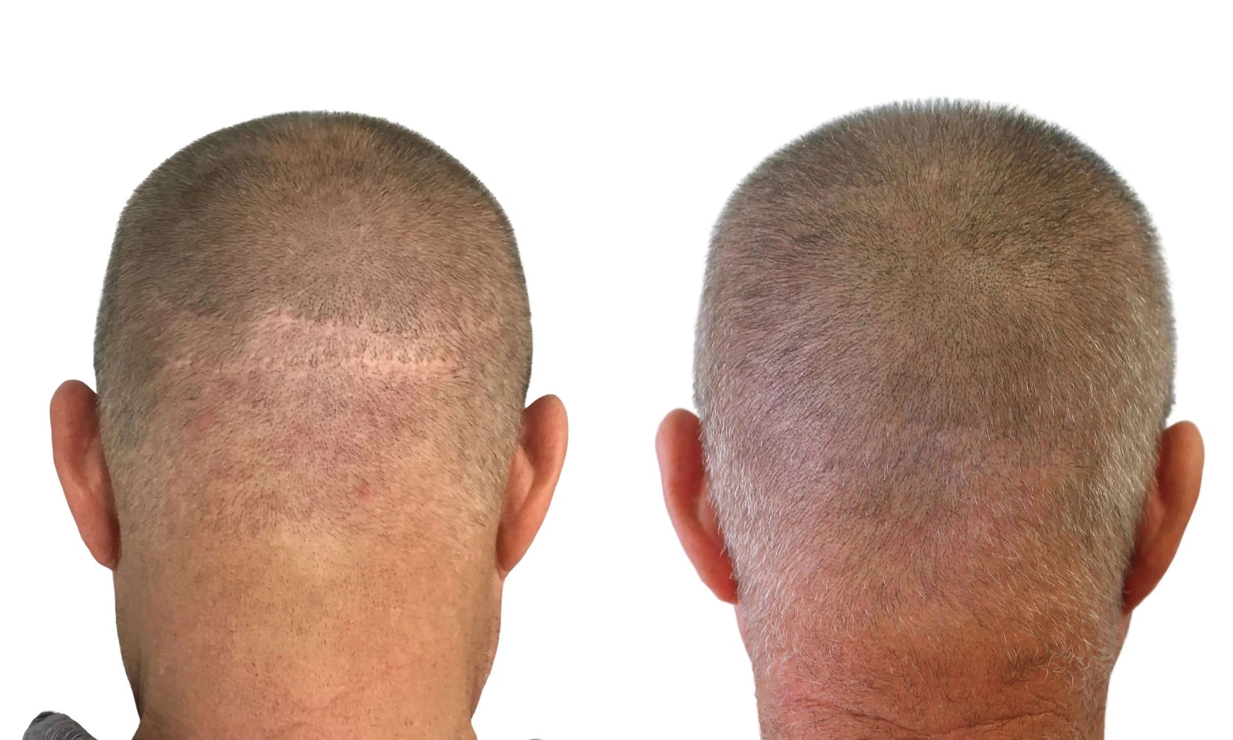 Scalp Micropigmentation For Scar Camouflage | The SMP Guy
