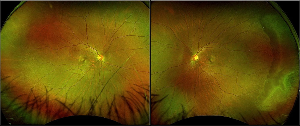 Optos Daytona plus Retinal Imaging is here!