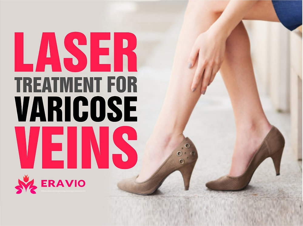 Laser Therapy for Varicose Veins