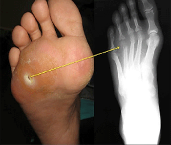 Wagner Grade 3 DFUs: Exploring Deeper Risks of Osteomyelitis