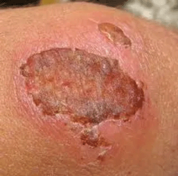 What Does Crust Look Like on Wounds? | Crusting Explained