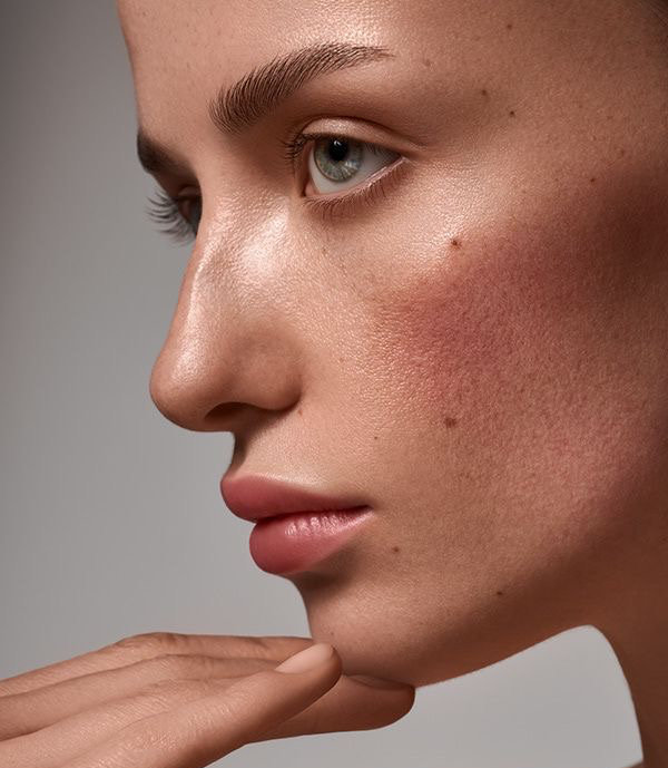 Rosacea (Ellipse IPL laser) | BioGlow Skin Clinic