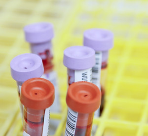 fragile x syndrome test uk