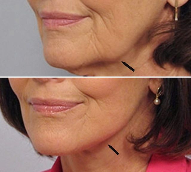 PM4U | FIBROBLAST BEFORE/AFTER
