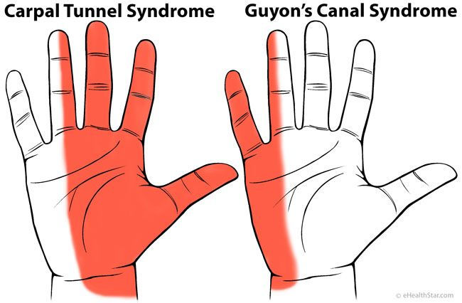 Cyclist's Palsy-Hand pain