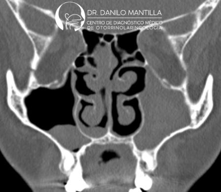 Tumores nasales | Dr. Danilo Mantilla ORL | Diagnóstico y tratamiento ...