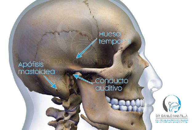 Mastoidectomía | Dr. Danilo Mantilla ORL | Cirugía de colesteatoma ...