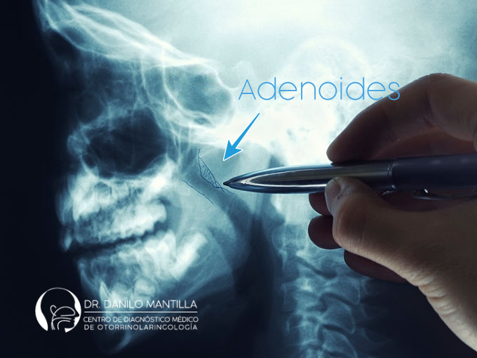 Hipertrofia de Amígdalas | Adenoides | Dr. Danilo Mantilla ORL ...