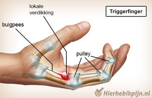 Springvinger | Dr. Van Parys Ortho