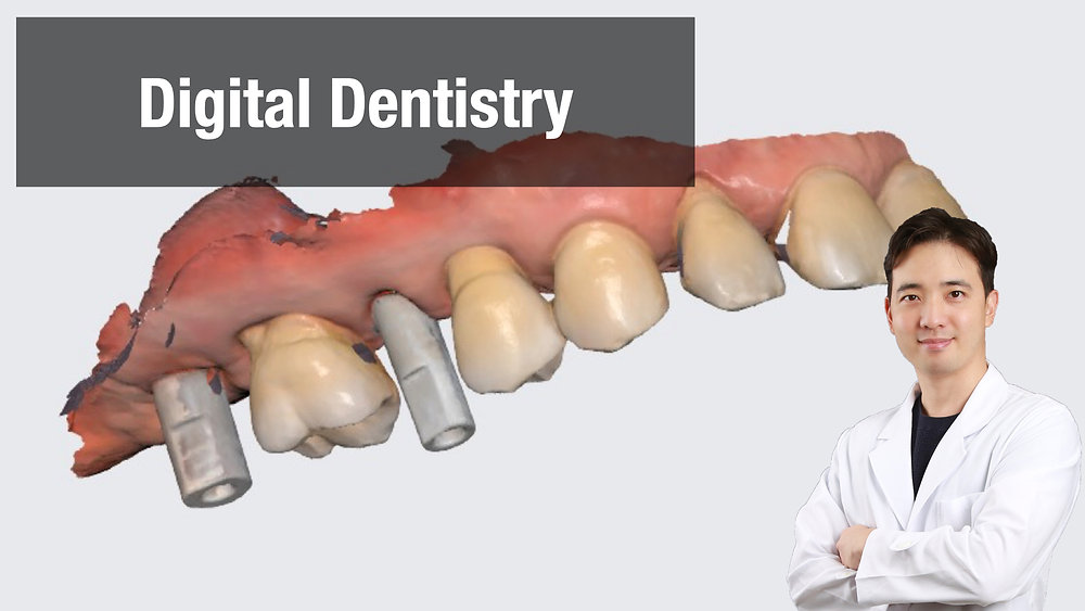 Digital work flow:Model-less implant supported crown restoration ...