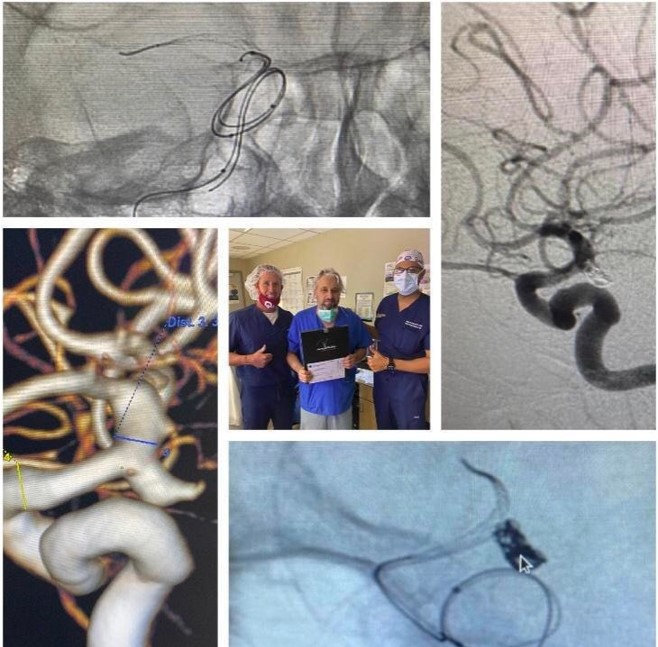 Ruptured Pcom Aneurysm Treated With Comaneci 17