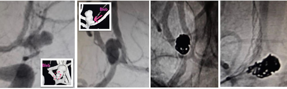 Comaneci Assisted Coiling - Ruptured ACOM