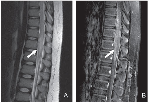 Mielite transversa: causas, sintomas, tratamento e evolução