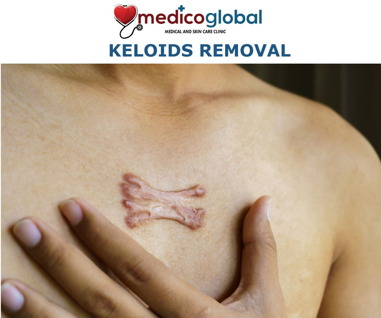 keloids under tattoo