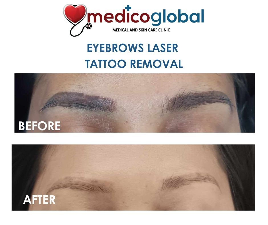Eyebrows - Laser Tattoo Removal | Medico Global Clinic