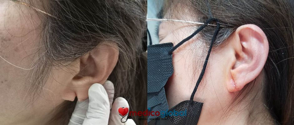 Ear Lobe Repair | Medico Global Clinic