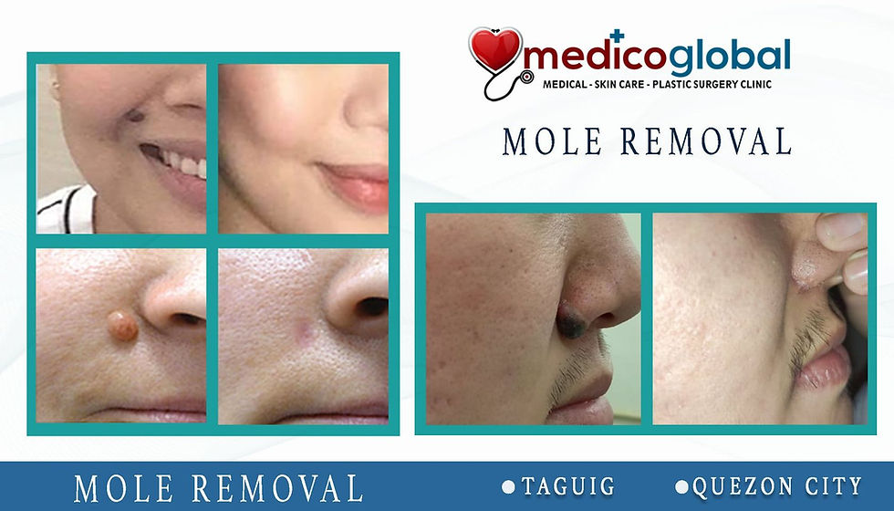 Mole Removal Mole Removal