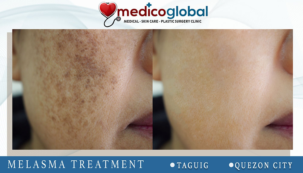 MELASMA LASER THERAPY