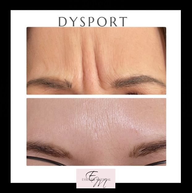 ESSENCE MEDICAL | Botox and Dysport® Treatments