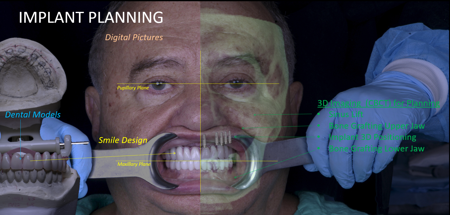 Implant 3D Digital Planning | Oasis Dental Implant Specialists