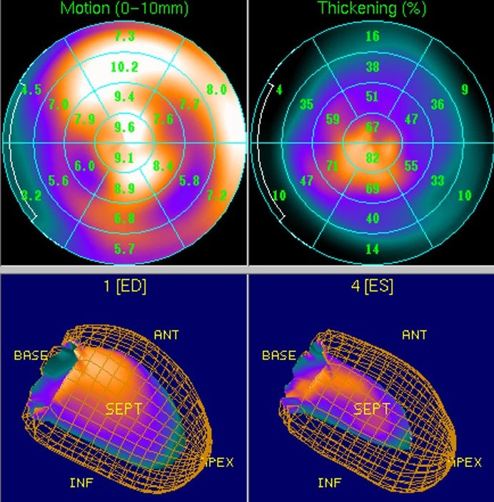 Heart Perfusion Scan
