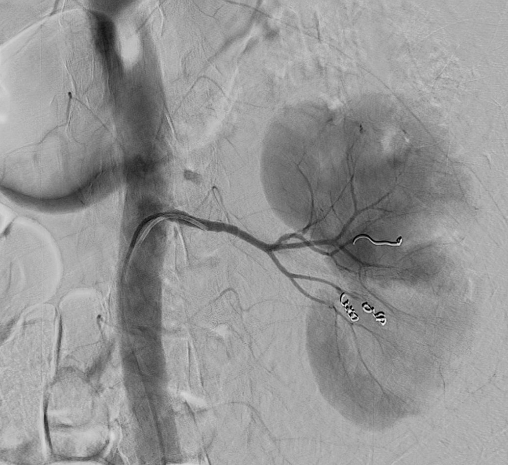 Embolisation for bleeding
