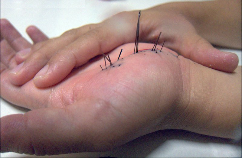 Sea Urchin Awareness: Vital Safety and Treatment Tips for Hawaii