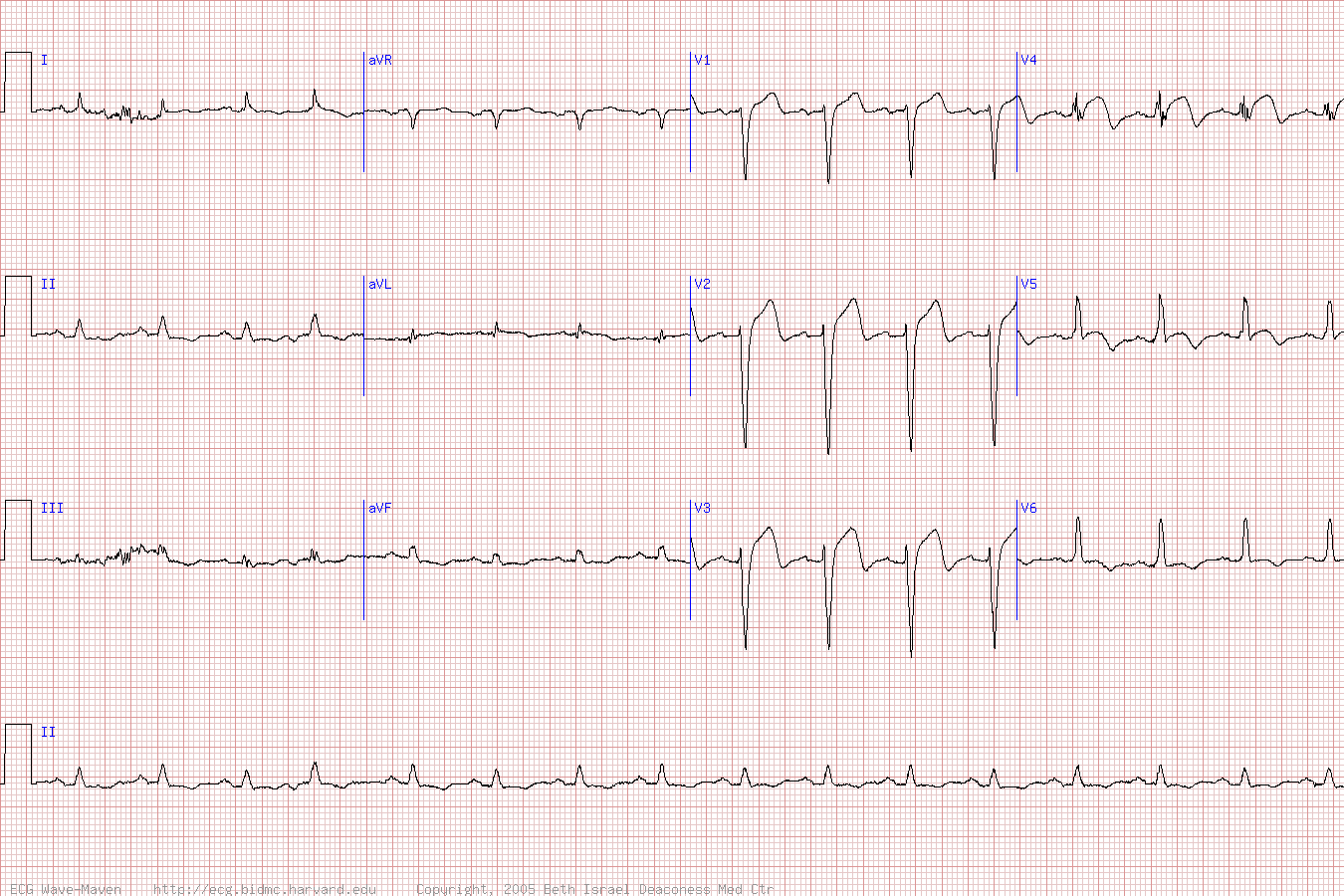 Ostre zespoły wieńcowe | kardiologiaratunkowa