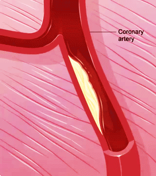 Ataques Cardíacos | Heart Attacks