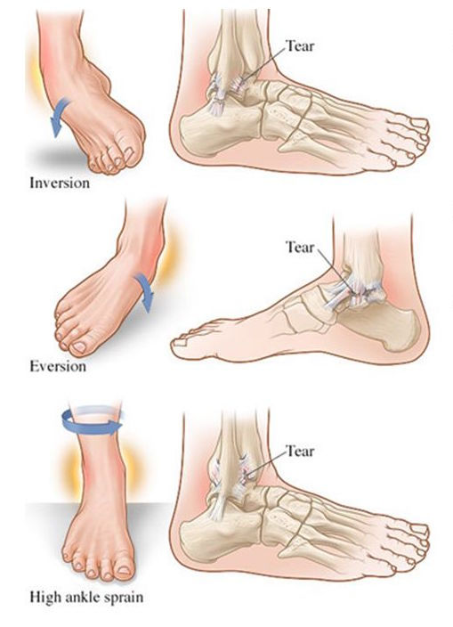 Ankle Sprains in Soccer - Prevention and Rehabilitation