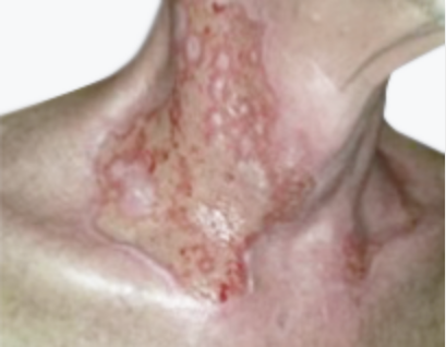 Revolutionising the Treatment of Oral Mucositis and Radiation Dermatitis