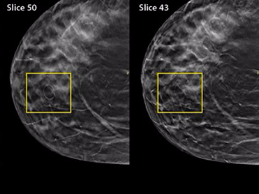 Mammography Skin Markers | OIS