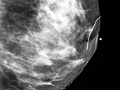 Mammography Skin Markers | OIS