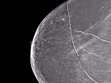 Mammography Skin Markers | OIS