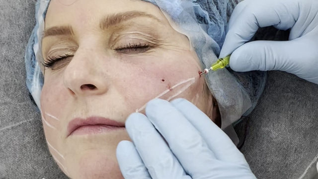 FULL FACE 8 Vector Thread Lift