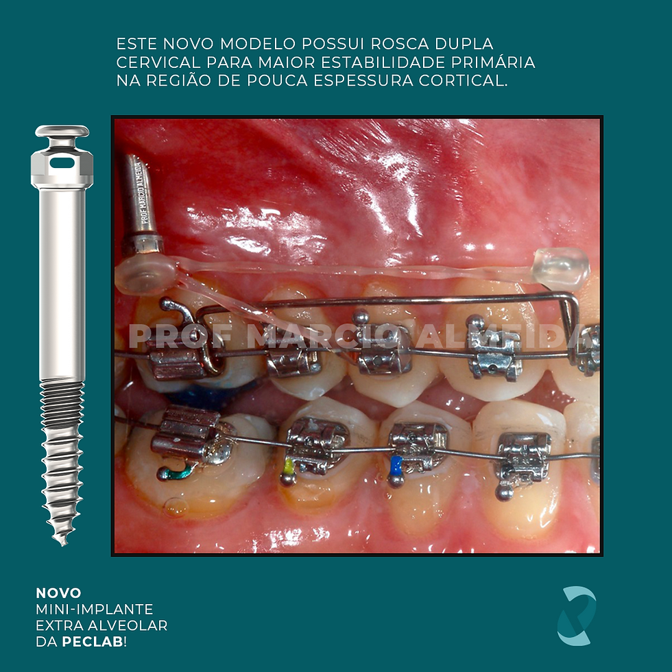 🌟NOVO🌟 Mini-implante Extra Alveolar da PecLab!