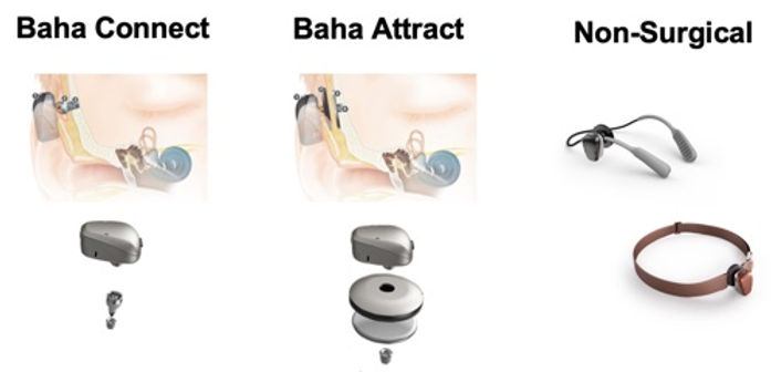 Bone Anchored Hearing Aid (Baha)