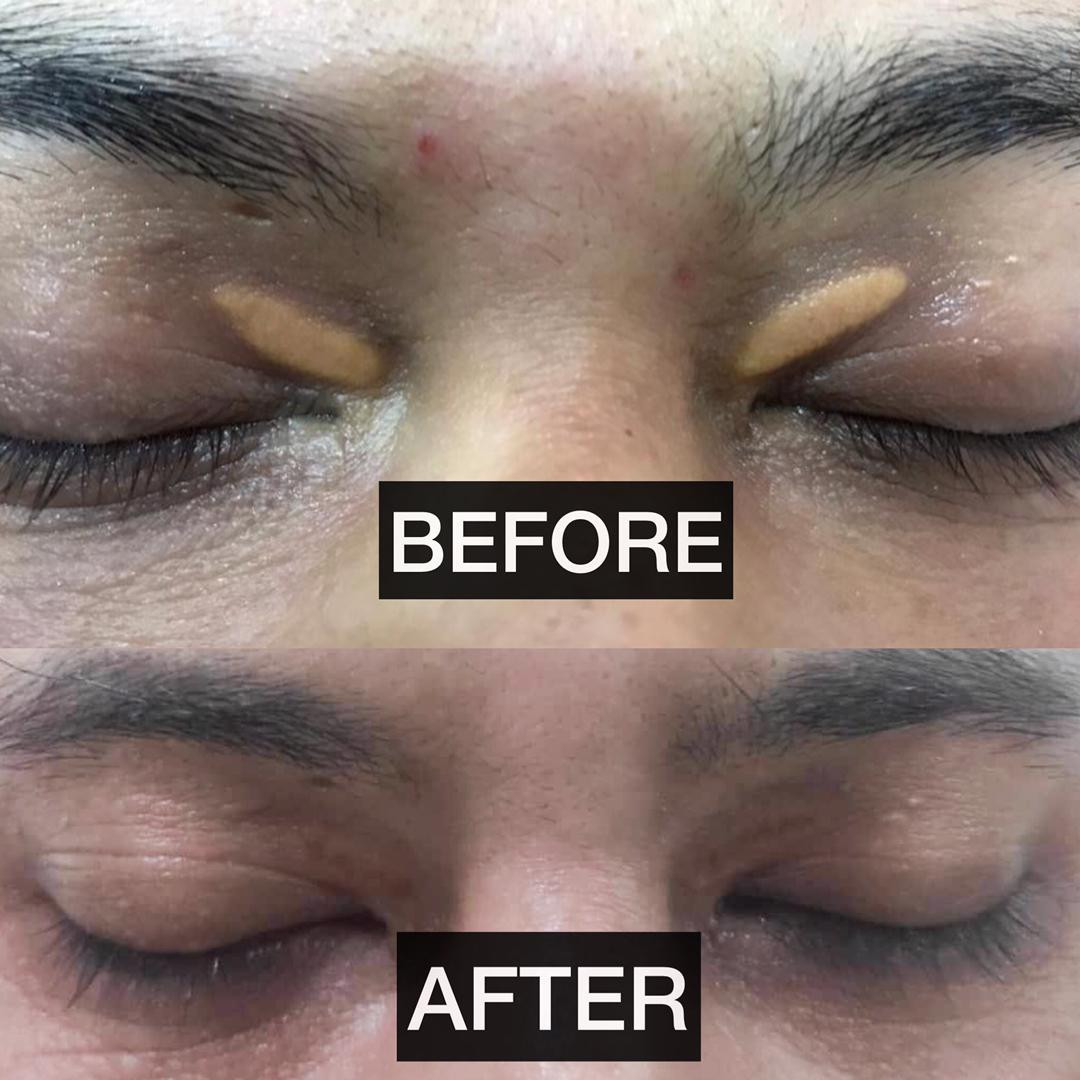 XANTHELASMA AND SYRINGOMA REMOVAL | KLINIK DR BAZILAH